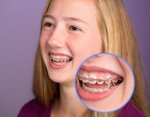 How Do Braces Work? | American Association of Orthodontists