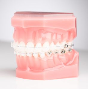 How Do Braces Work? | American Association of Orthodontists