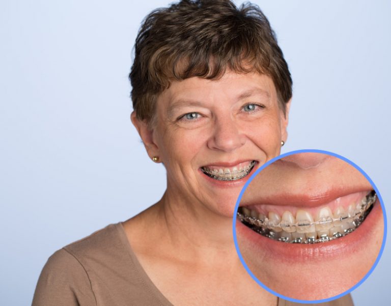 How Do Braces Work? | American Association of Orthodontists