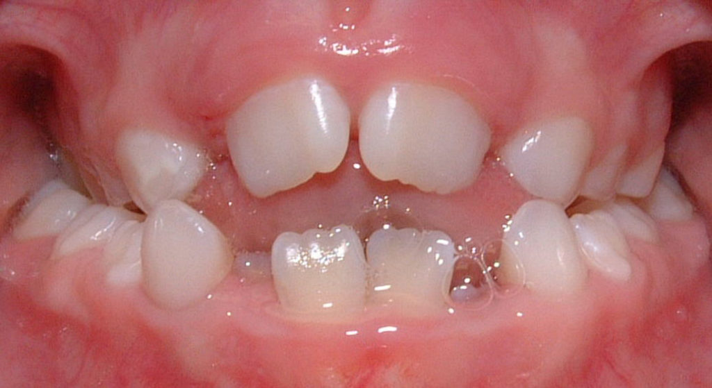 7 Types Of Bite Problems and Their Orthodontic Solutions | American ...