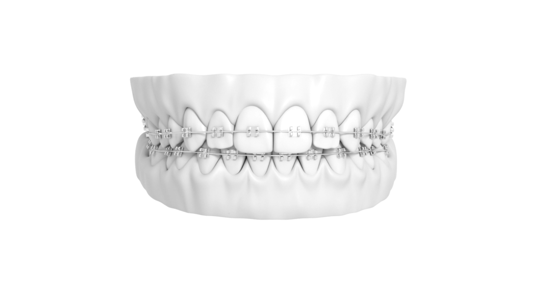 How Braces Work: A Comprehensive Guide | American Association of ...