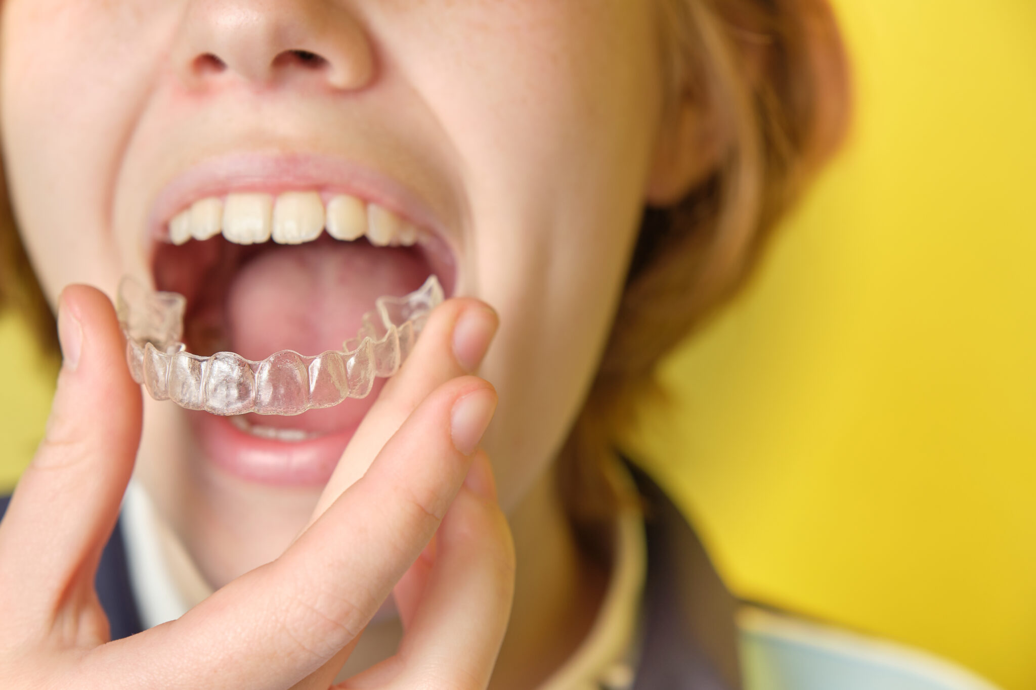 Clear Aligners | American Association of Orthodontists
