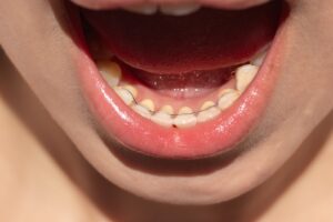 Retainers After Orthodontic Treatment | American Association of ...