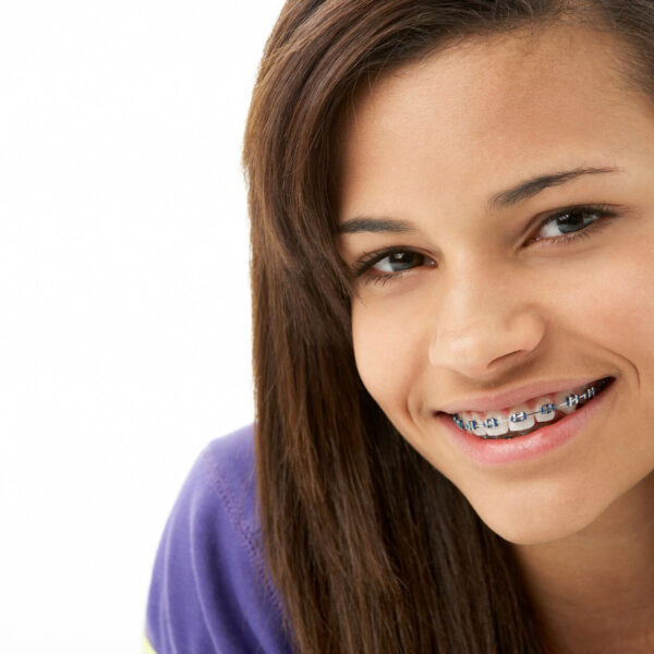 What is a Palatal Expander, and What is it Used For? | American ...