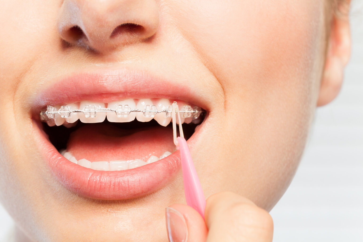 Orthodontic Elastics: Are They For You? | American Association of ...