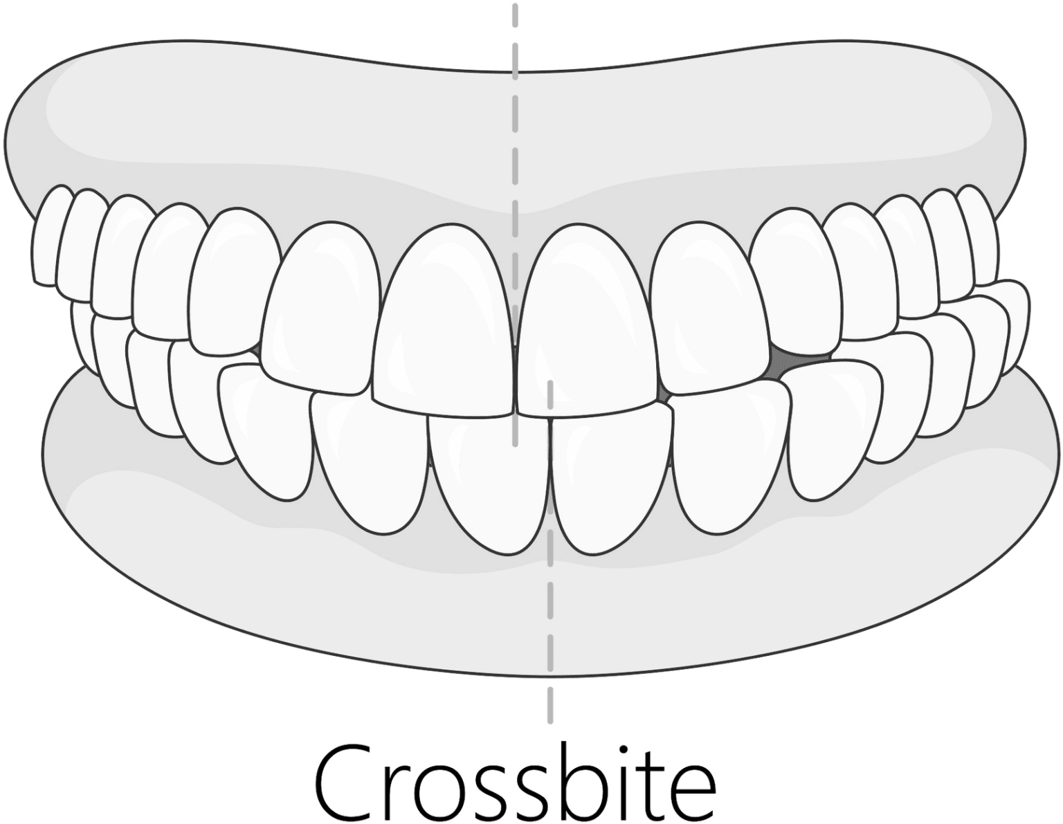What Is A Crossbite? | American Association of Orthodontists