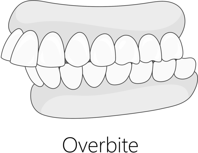 Understanding Deep Bites: Causes & Treatment | American Association of ...