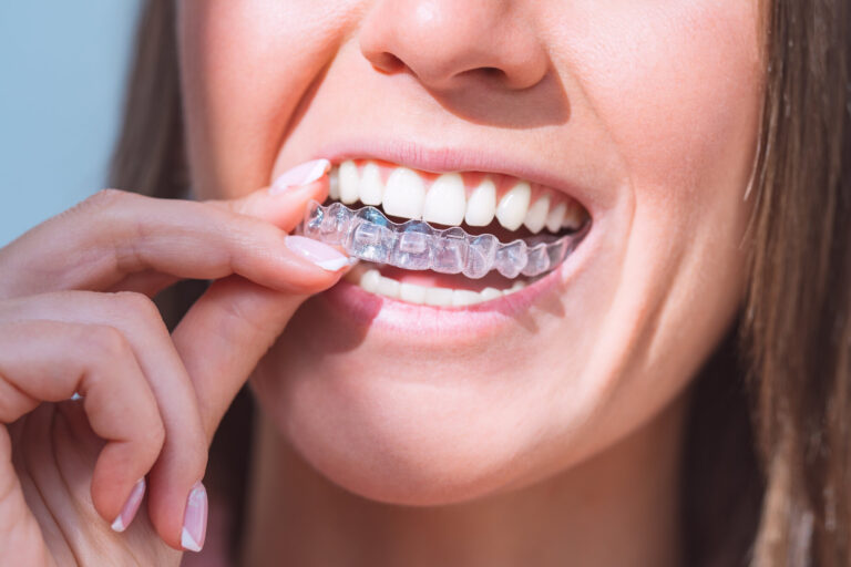 What Are Dental Retainers? | American Association of Orthodontists