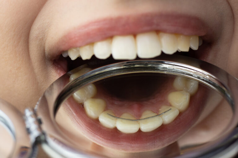 What Are Dental Retainers? | American Association of Orthodontists
