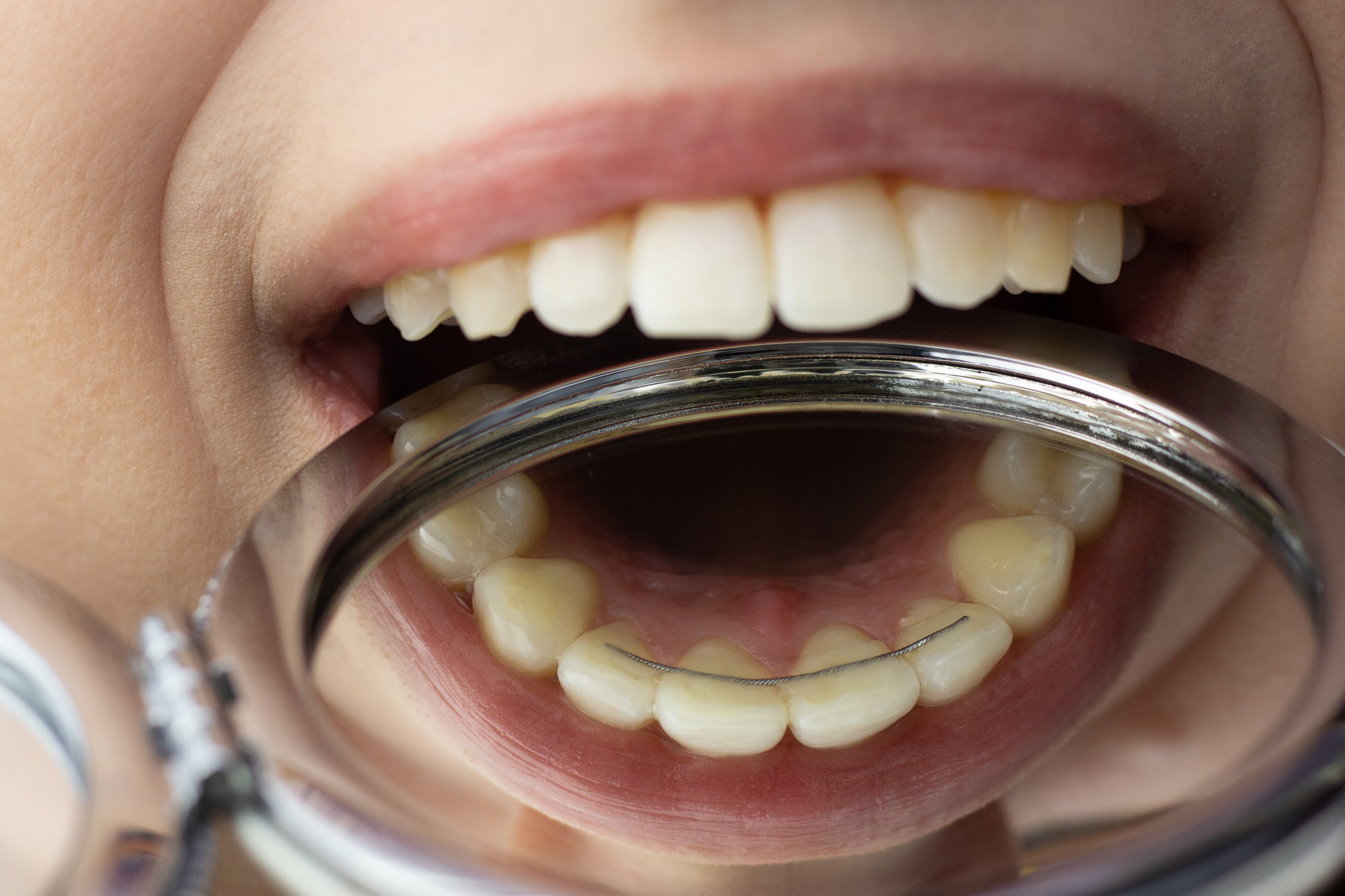 What Are Dental Retainers? | American Association of Orthodontists