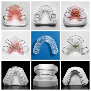 How Do Braces Work? | American Association of Orthodontists