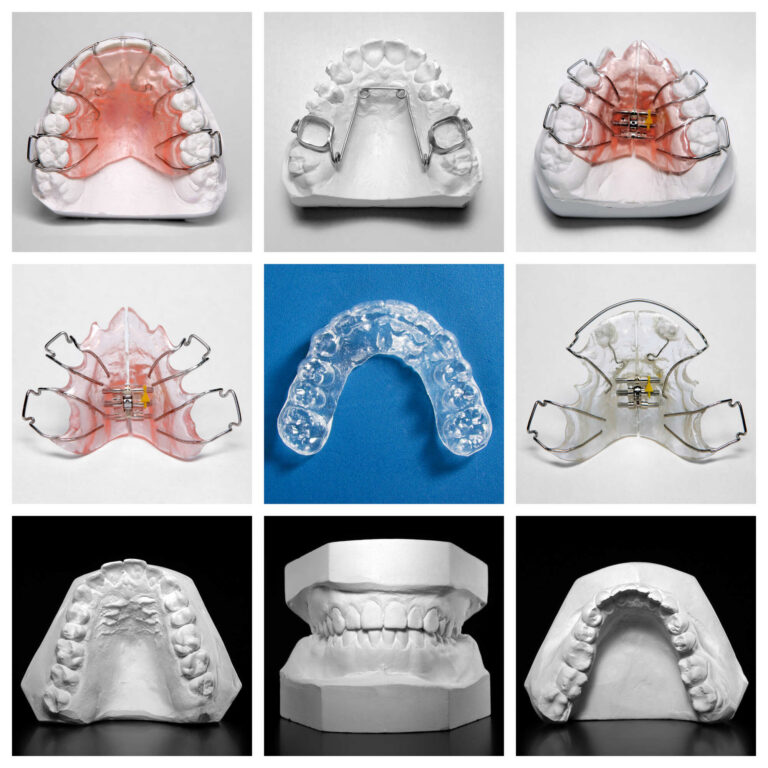 Understanding Deep Bites: Causes & Treatment | American Association of ...
